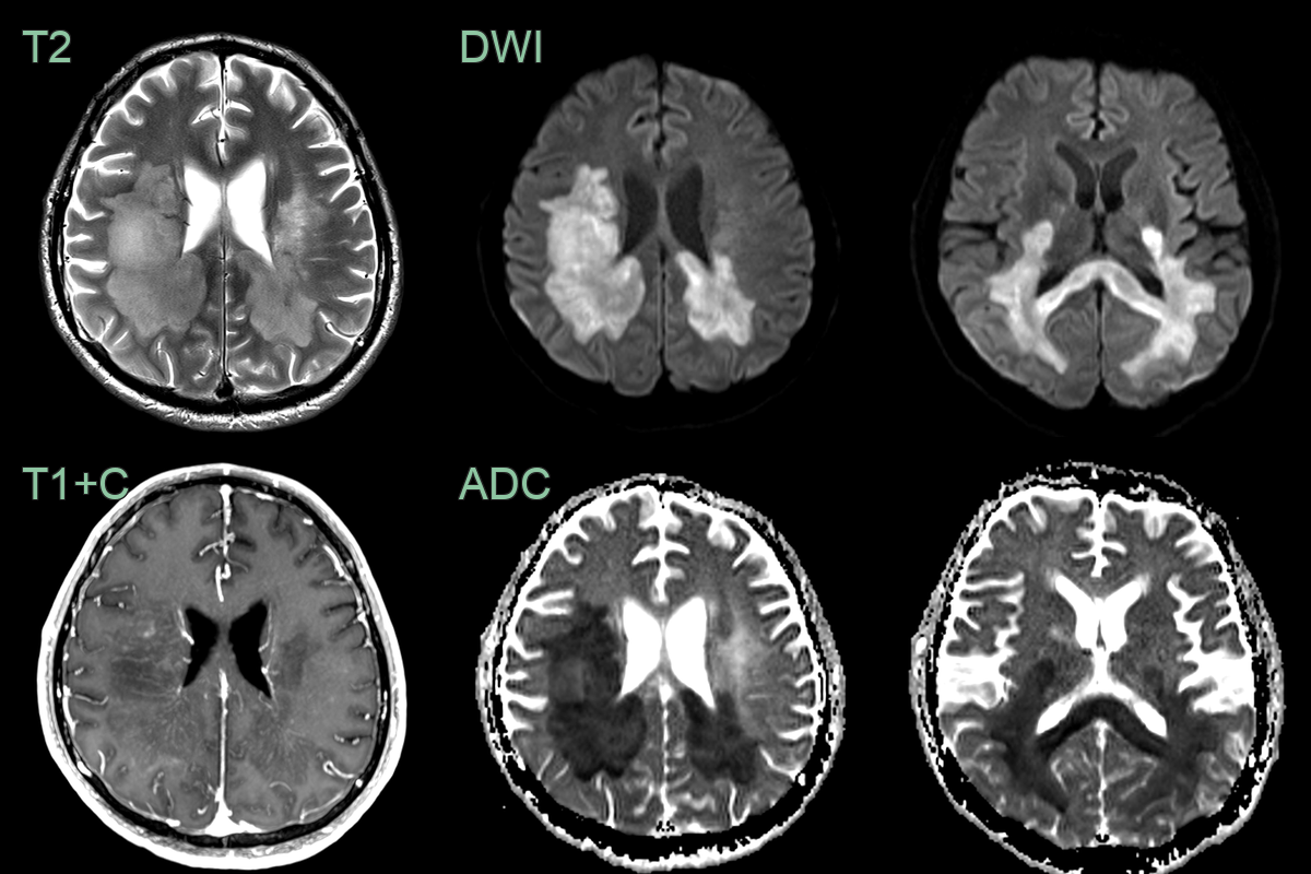 Multiple Sclerosis (MS) - Neuroradiology