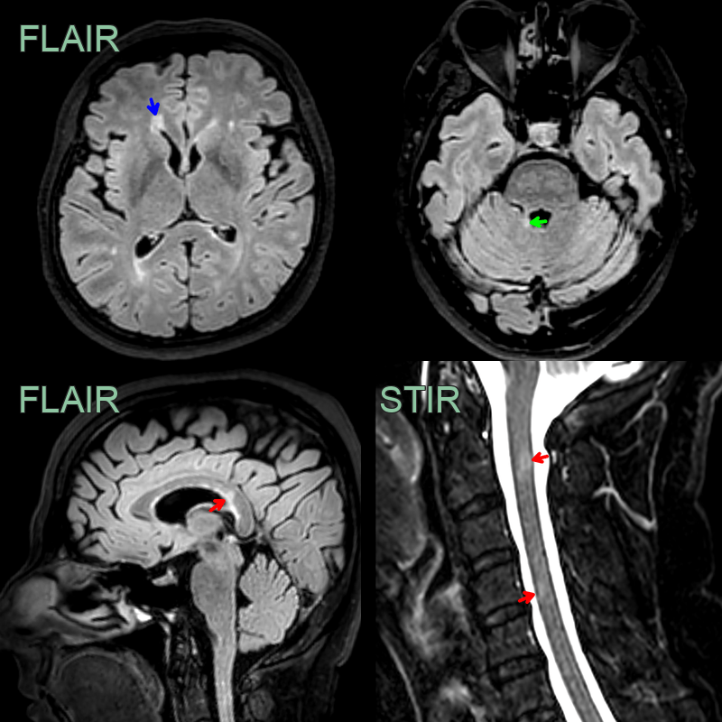 Multiple Sclerosis (MS) - Neuroradiology