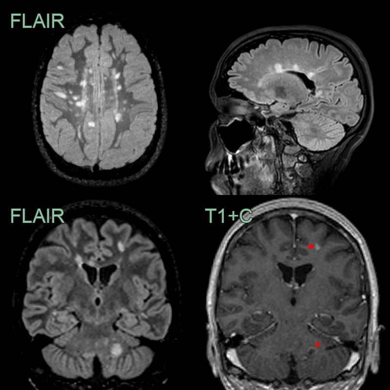 Multiple Sclerosis (MS) - Neuroradiology
