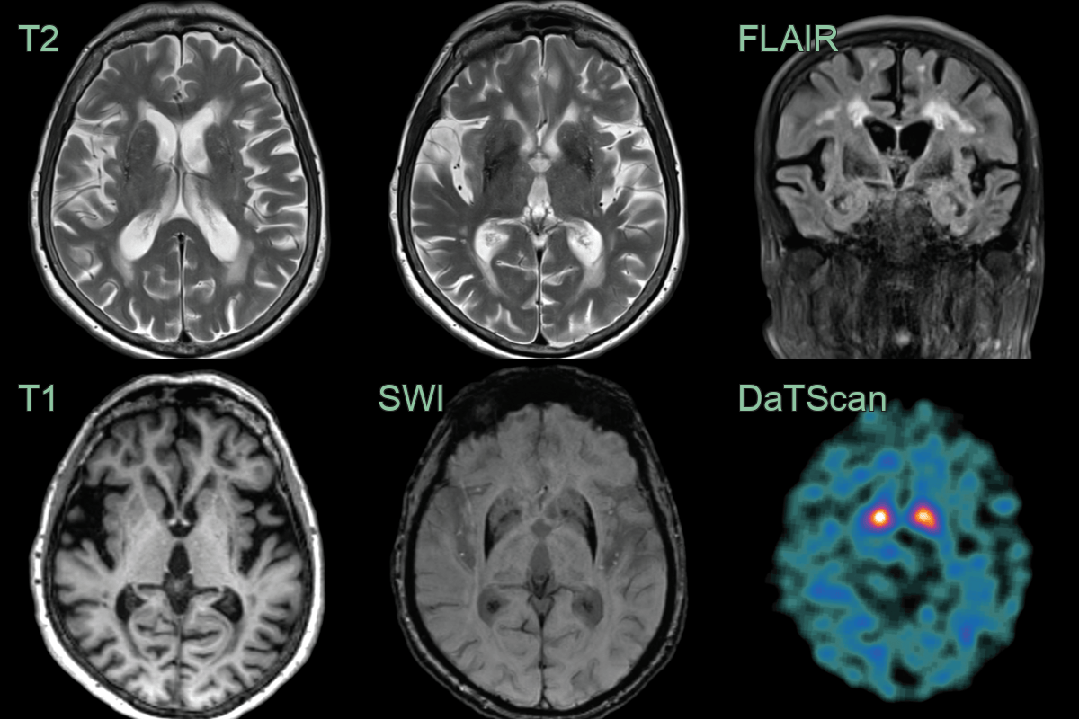 Multisystem Atrophy - Parkinsonian Type (MSA-P) - Neuroradiology