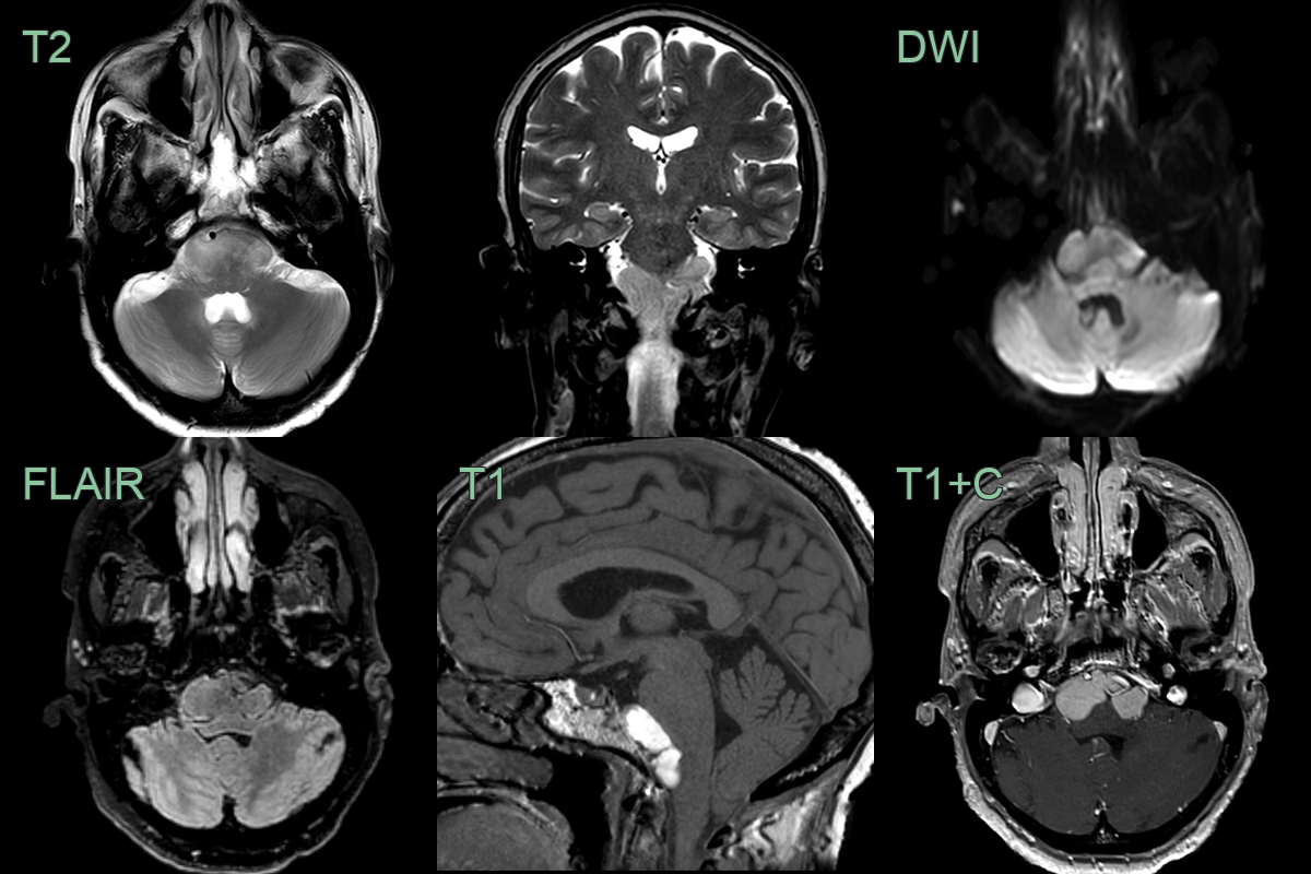 Neurenteric cyst - Neuroradiology