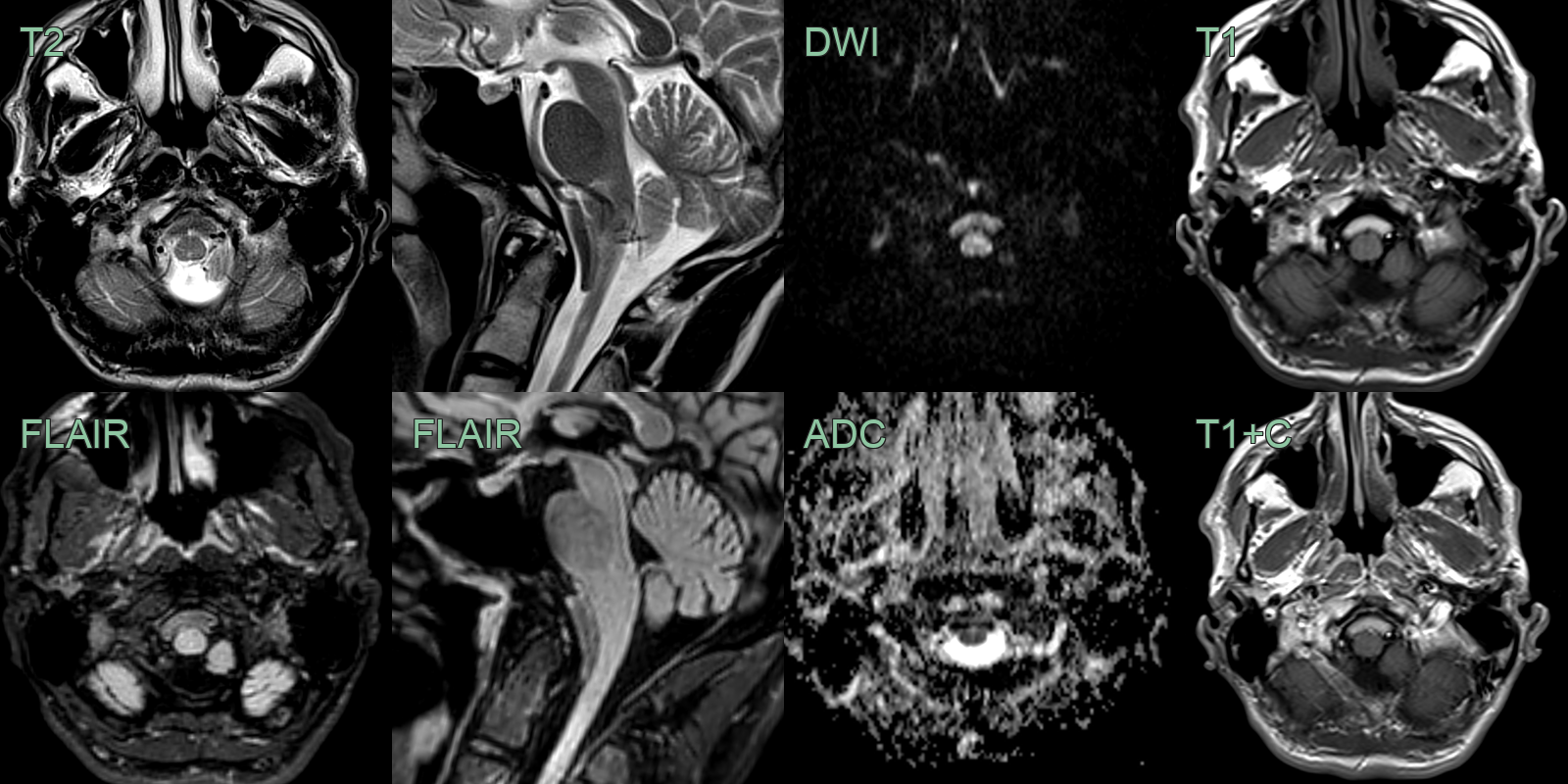 Neurenteric cyst - Neuroradiology