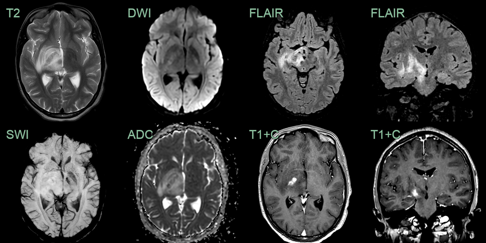 Neuro behcets disease - Neuroradiology