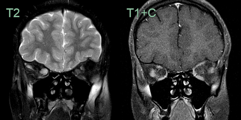 Optic pathway glioma - Neuroradiology