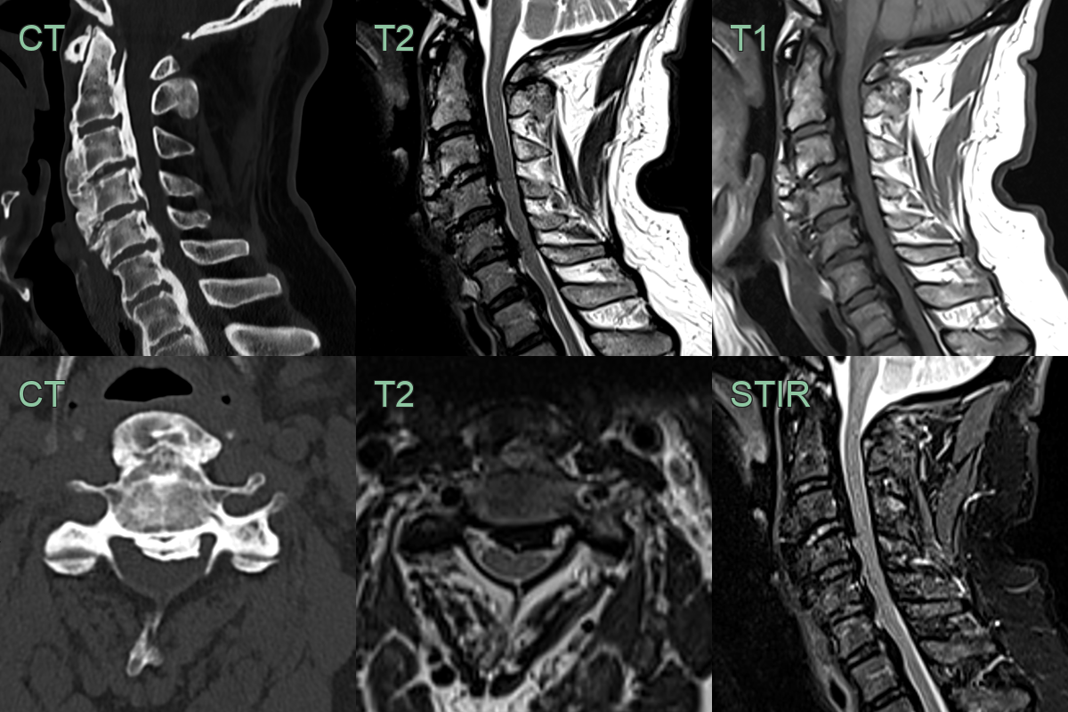 Ossificiation of the posterior longitudinal ligament - Neuroradiology