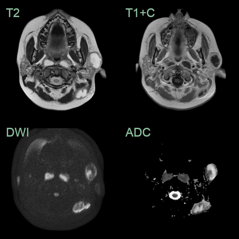 Parotid abscess - Neuroradiology