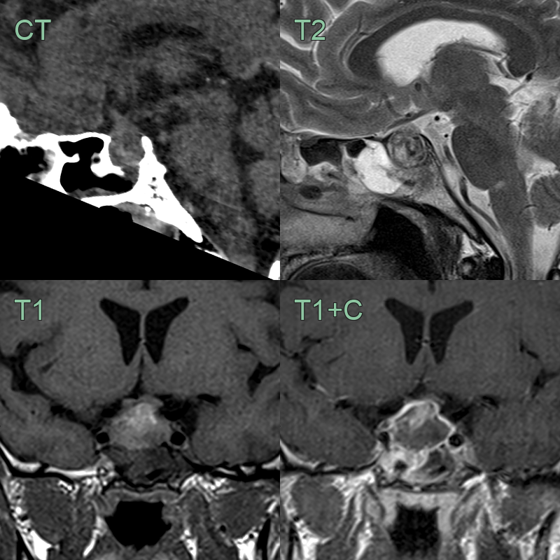 Pituitary apoplexy - Neuroradiology