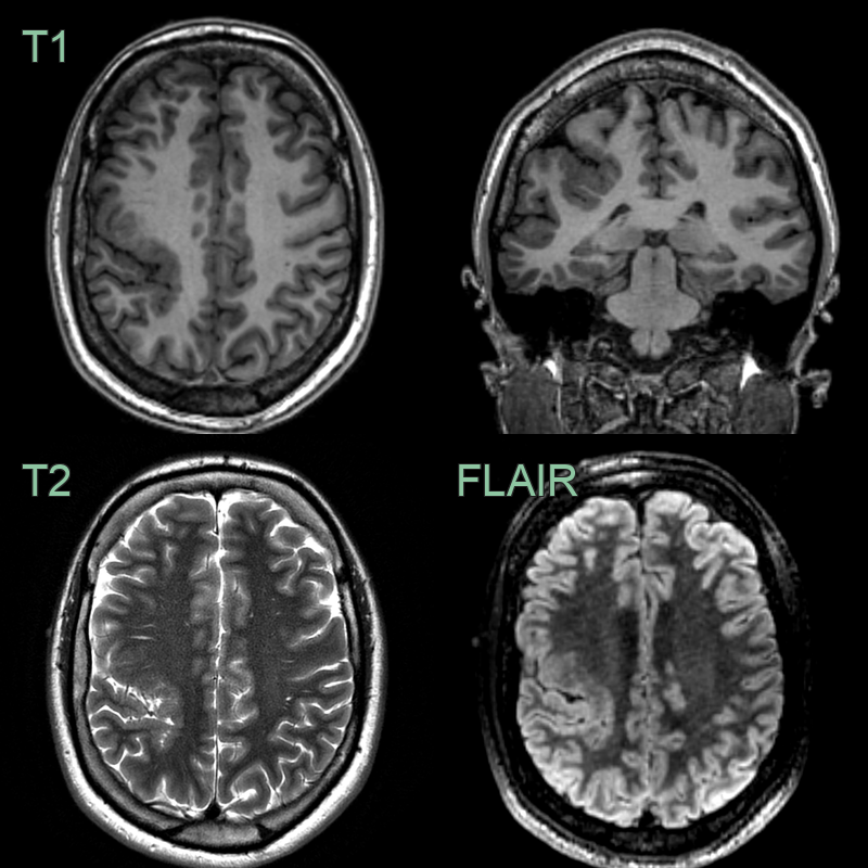 Polymicrogyria - Neuroradiology