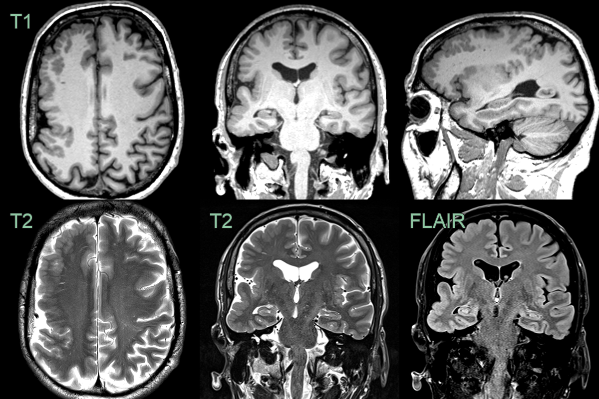 Polymicrogyria - Neuroradiology