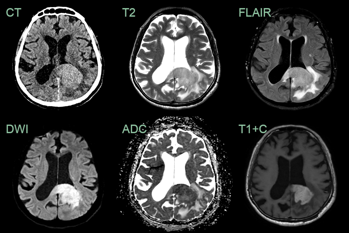 Primary CNS lymphoma - Neuroradiology