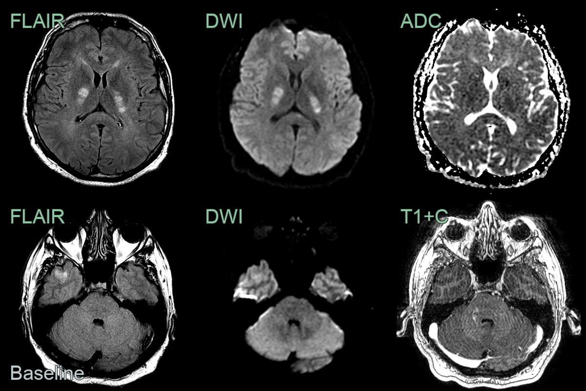 Primary CNS lymphoma - Neuroradiology