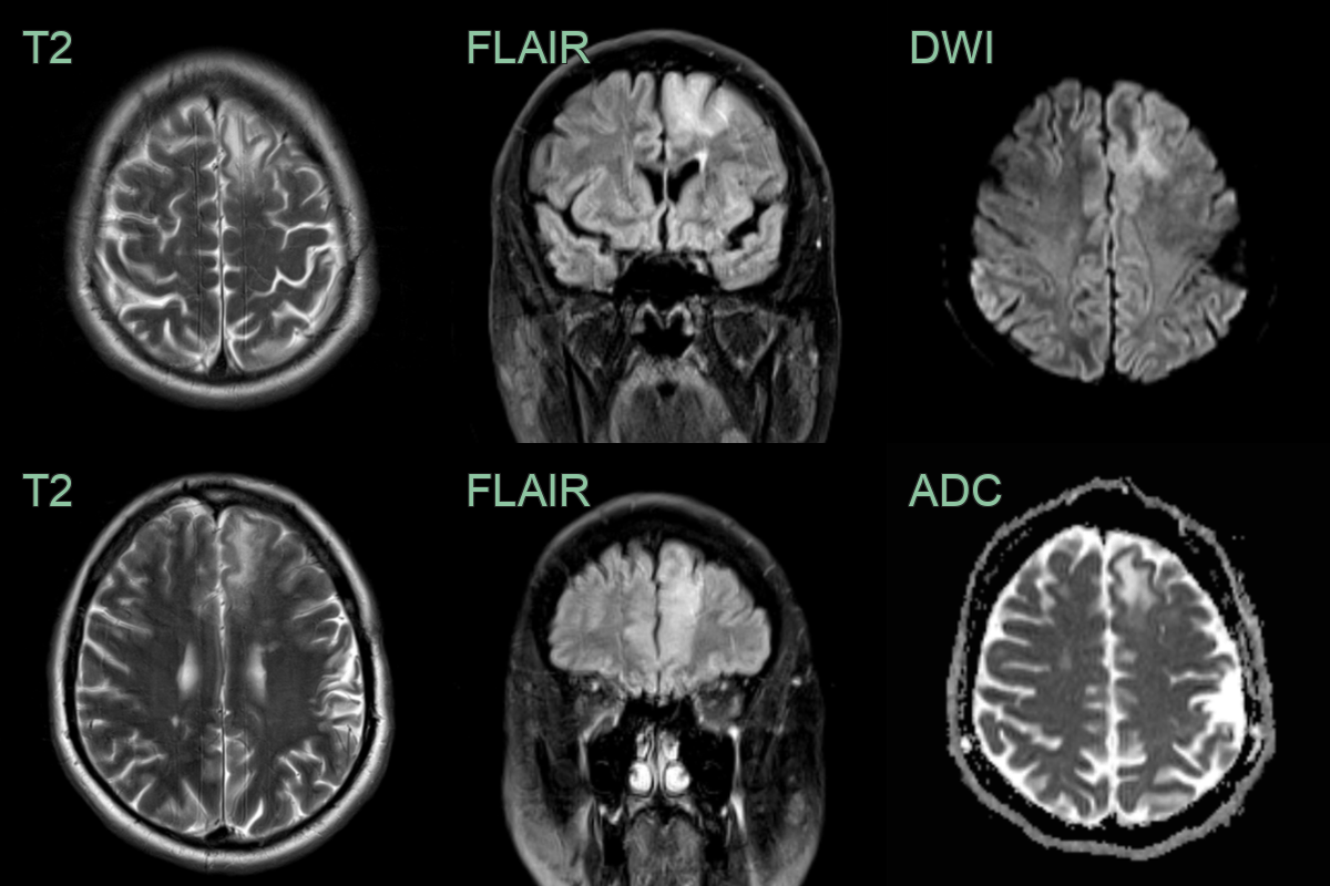 Progressive Multifocal Leukoencephalopathy (PML) - Neuroradiology