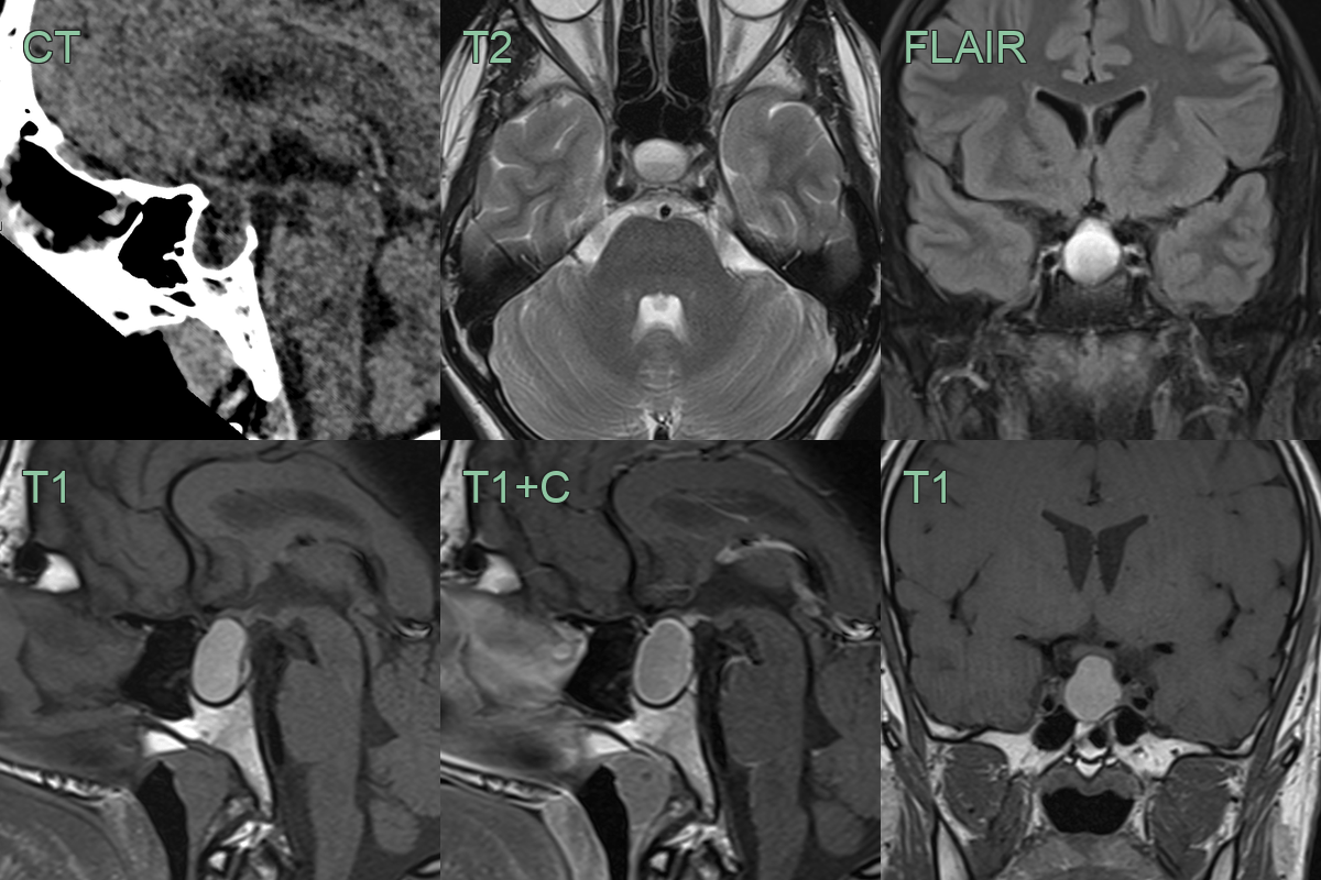Rathke's cleft cyst - Neuroradiology