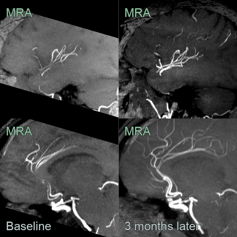 Reversible Cerebral Vasoconstriction Syndrome (RCVS) - Neuroradiology