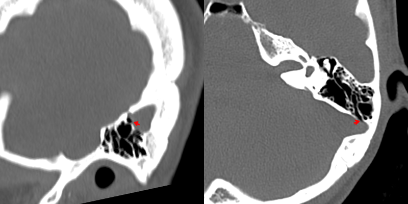 Sigmoid sinus dehiscence - Neuroradiology