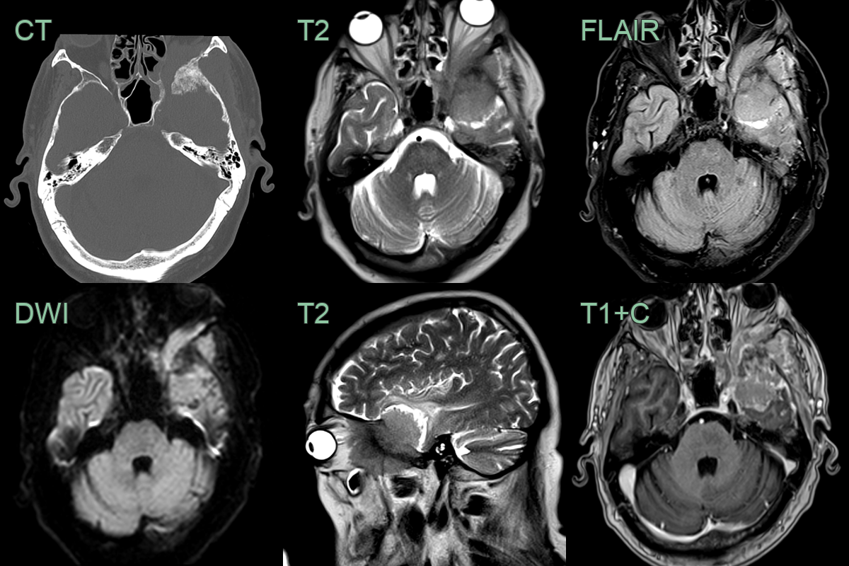 Skull base metastasis - Neuroradiology
