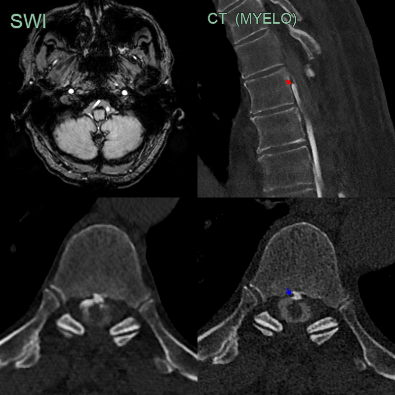 Spinal CSF leak - Neuroradiology