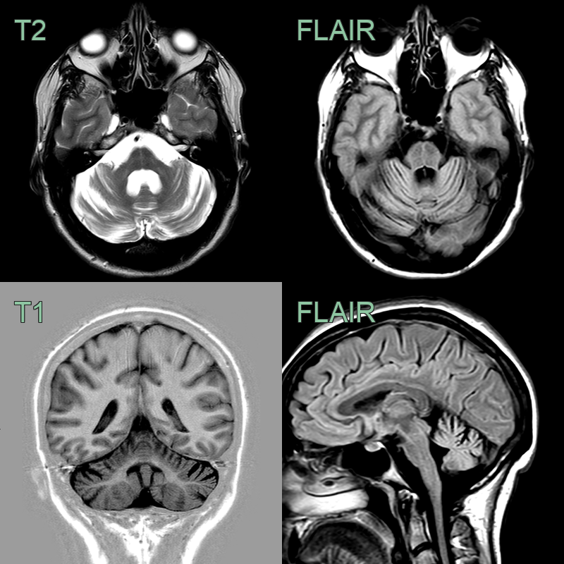 Spinoerebellar Ataxia (SCA) - Neuroradiology
