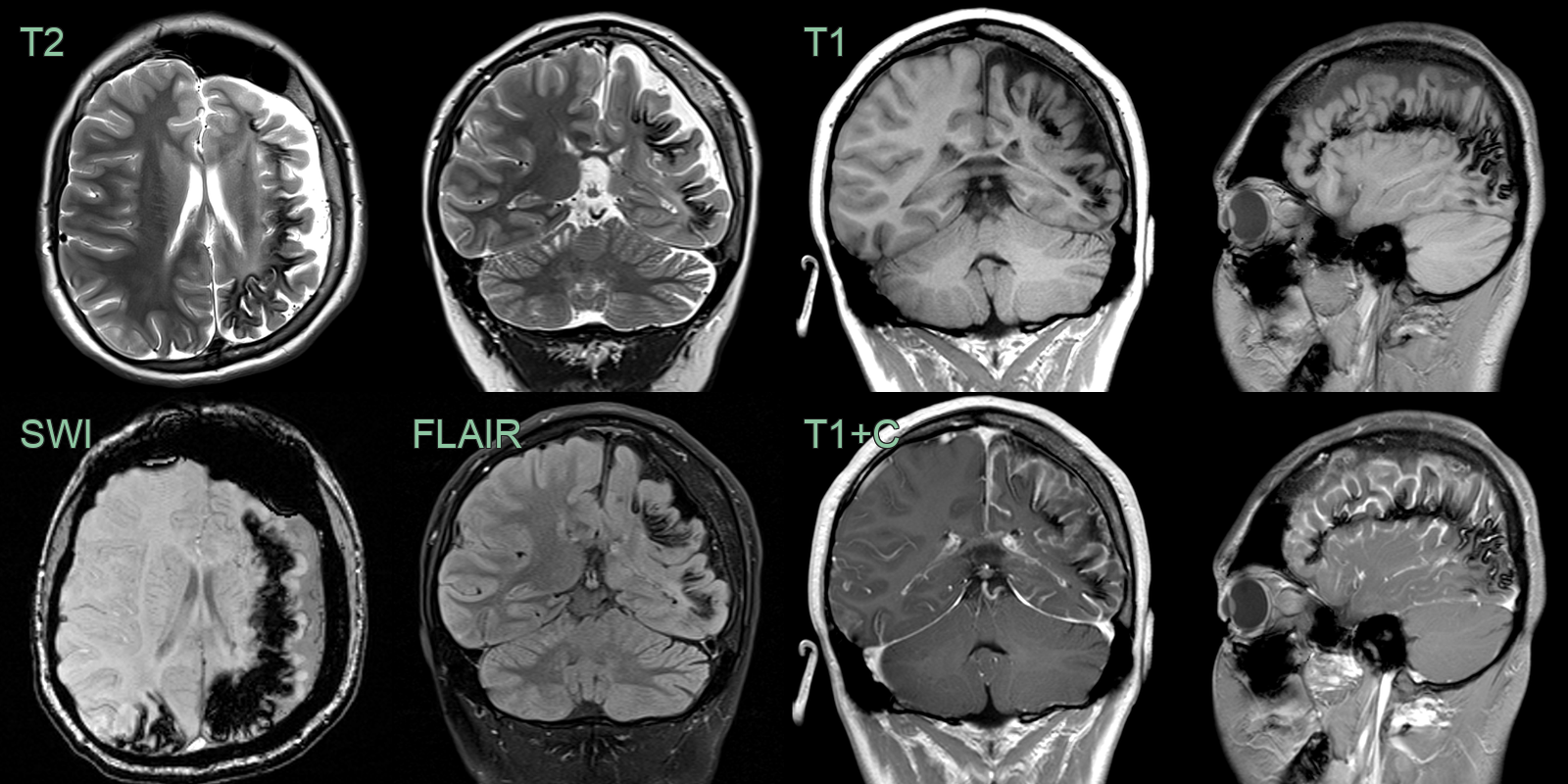 Sturge-Weber Syndrome - Neuroradiology
