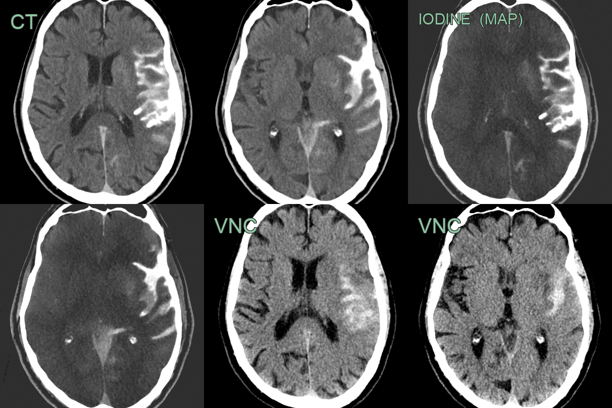 Subarachnoid Hemorrhage (SAH) - Neuroradiology