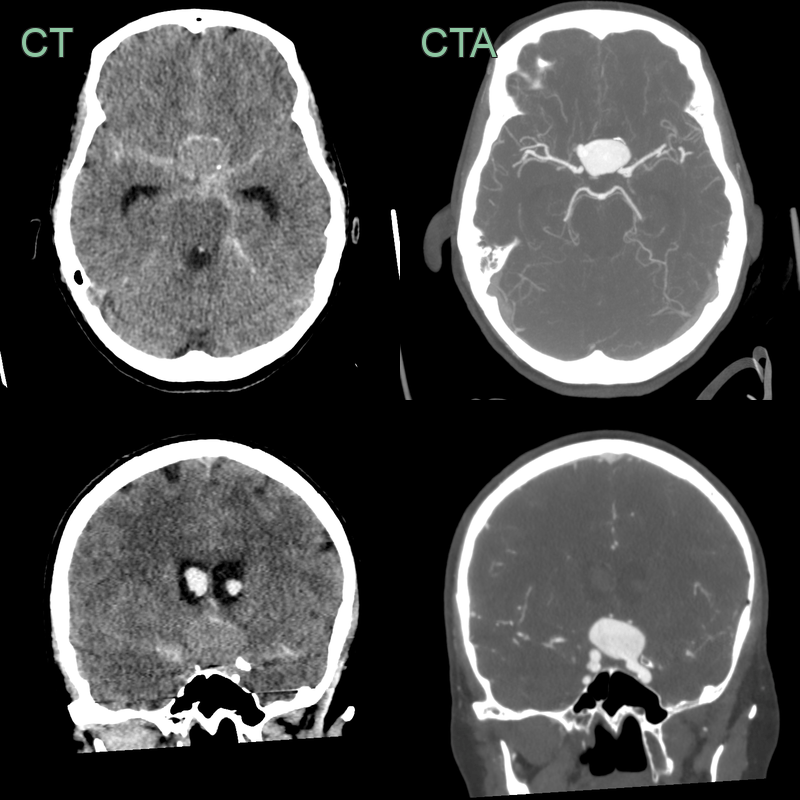 Subarachnoid Hemorrhage (SAH) - Neuroradiology