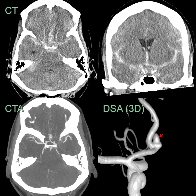 Subarachnoid Hemorrhage (SAH) - Neuroradiology
