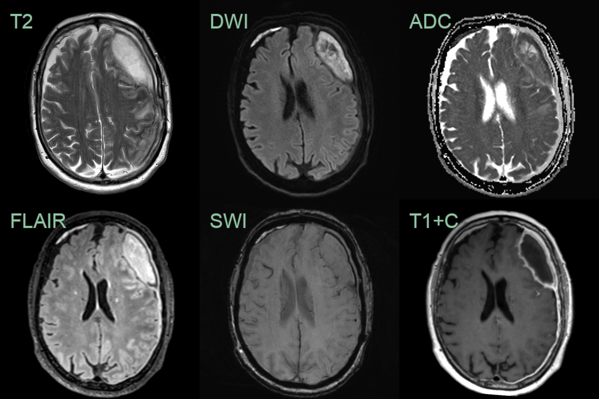 Subdural empyema - Neuroradiology