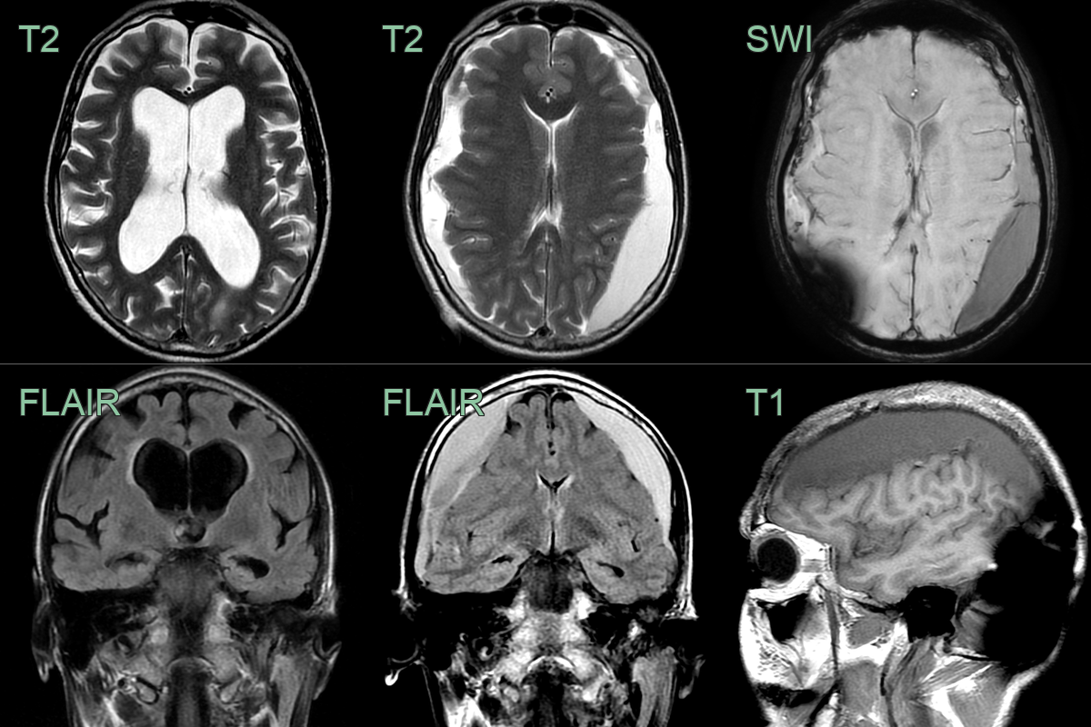 Subdural hygroma - Neuroradiology