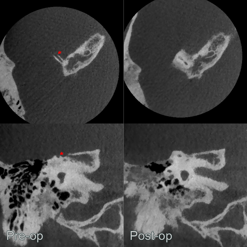 Superior semicircular canal dehiscence syndrome - Neuroradiology
