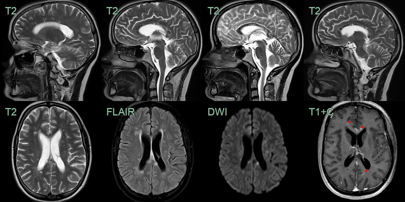 Susac syndrome - Neuroradiology