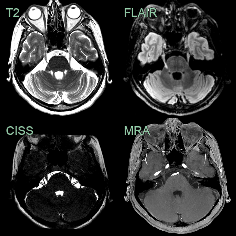 Trigeminal neuralgia - Neuroradiology