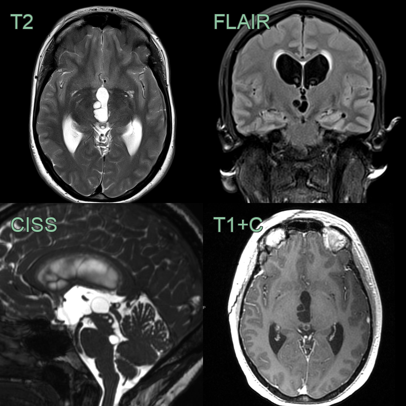 Tumefactive perivascular spaces - Neuroradiology