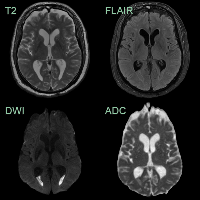 Ventriculitis - Neuroradiology