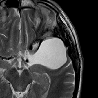 Arachnoid Cyst - Neuroradiology